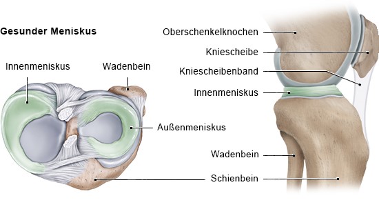Meniskusriss und Meniskusschaden - gesundheitsinformation.de